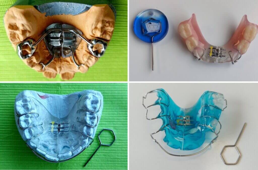 Orthodontic devices. Which ones are better? - стоматологічний блог ...